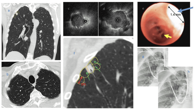 Interventional Pulmonary Fellowship Program | Montefiore Einstein