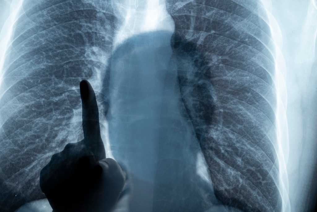 Pulmonary and Critical Care Fellowship Program | Montefiore Einstein
