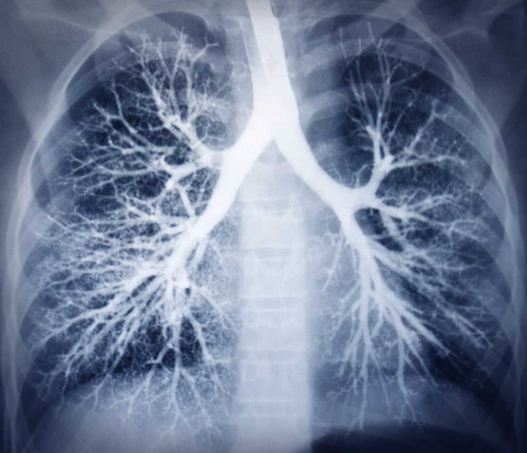 Interventional Pulmonary Fellowship Program | Montefiore Einstein